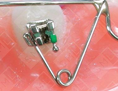 Multi-spring Cuspid Retraction Appliance U/L , Space Maintaining Tools ...